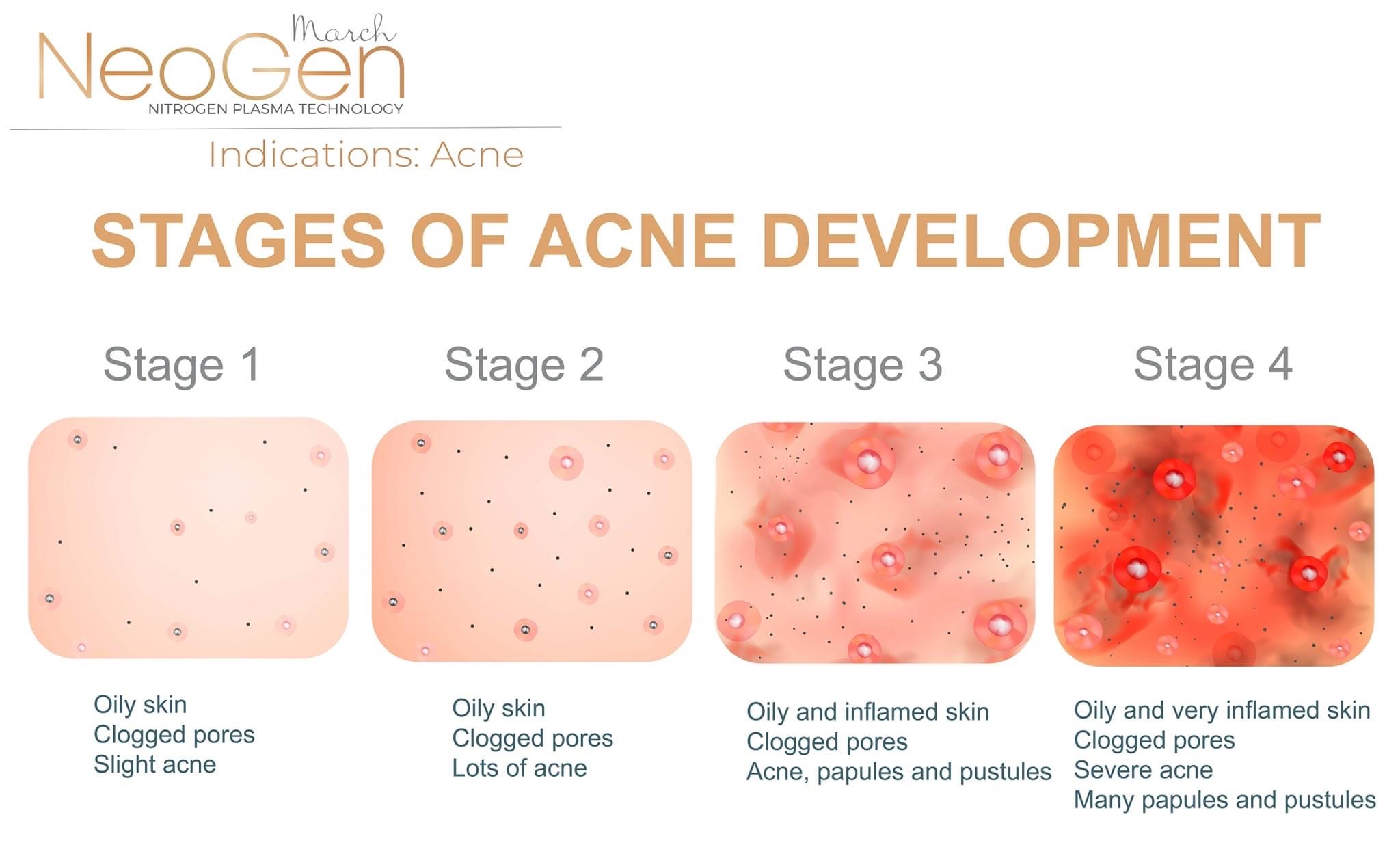 Five key benefits of having acne treated with the NeoGen plasma method ...